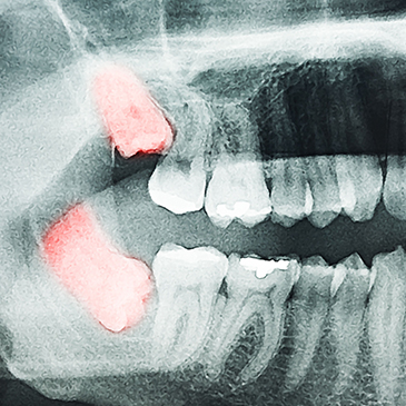 Endodontics - Hatfield Dental Care | Dentist in Doncaster, South Yorkshire